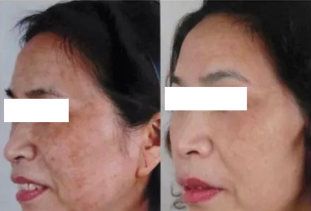 DEP®無針注氧亮肌療程 – Pureplus